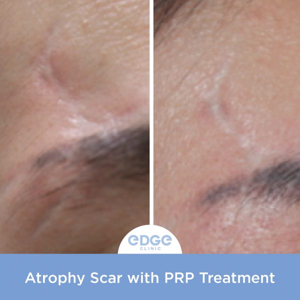 Atrophy Scar with PRP Treatment – Edge Clinic